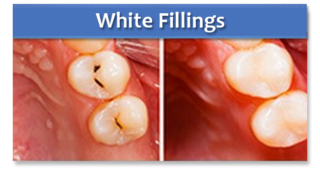 White Dental Fillings West Sussex | Dental Healthcare Practice